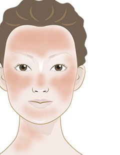 Sonnenallergie: Symptome, Behandlung und Vorbeugung