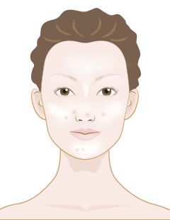 Stresspickel – Warum sie entstehen und was hilft