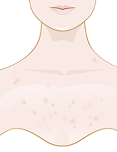 Leiden Sie unter Pickeln auf der brust? → So werden Sie sie los!