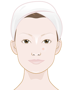 Pickel auf den Wangen → So wirst du sie los!